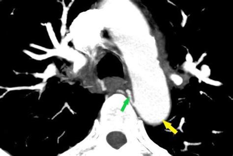Preprocedural Ct Aortogram Showing The Origin Of The Right Bronchial