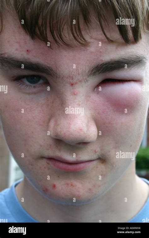 Mosquito Bite Swollen Eye Treatment At Georgia Challis Blog