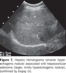 Cavernous Hemangioma Liver Ultrasound