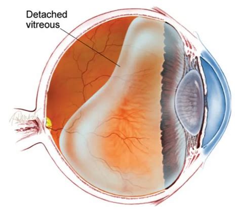 Posterior Vitreous Detachment Asia Retina Eye Surgery Centre