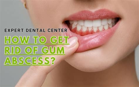 How To Get Rid Of An Abscess On Your Gum Detroit Chinatown