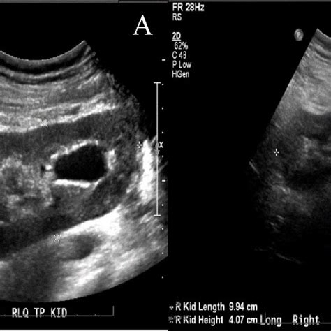 Case 2 Rus Before Ureteral Reconstruction A Showing Mild