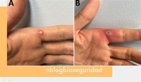 Viruela Del Simio Después De Una Lesión Ocupacional Por Pinchazo Con