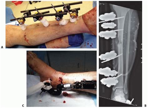 External Fixation Of The Mature Tibia Musculoskeletal Key