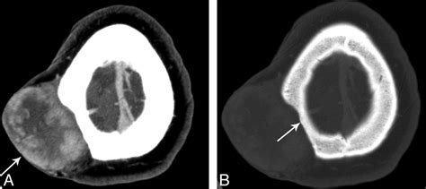 Dermatofibrosarcoma Protuberans Mri Appearance Of Recurrent