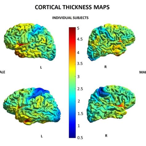 Cortical Maps Of Age Related Distribution Of Cortical Thickness In Download Scientific