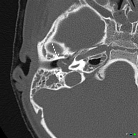 Tympanogram In Acute Otitis Media At Jeremy Fenner Blog