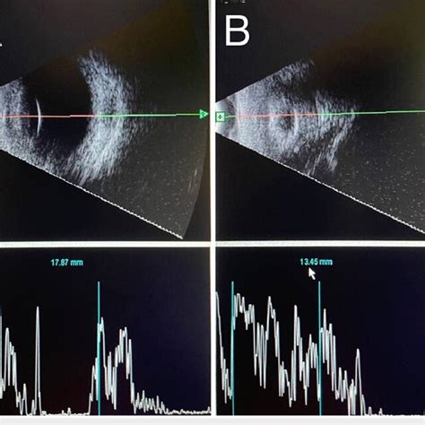 A Repeated B Scan A Right Eye Od Normal The Axial Length Is