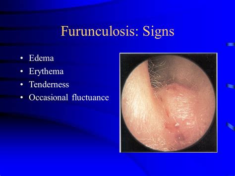 Furunculosis Ear
