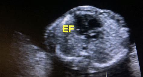 A Single Eif Within The Left Ventricle Courtesy Dr Bipul Biswas Md