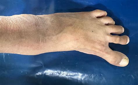 Understanding And Treating Hallux Varus A Success Story At Kossin Care