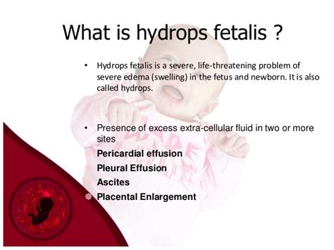 Hydrops