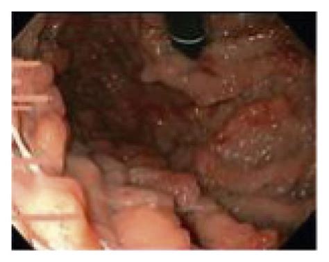 Egd Scopy Findings Panulcerative Gastritis And Ulcerative Duodenitis Download Scientific