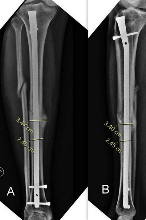 Is Nail Dynamization Beneficial After Twelve Weeks An Analysis Of 37