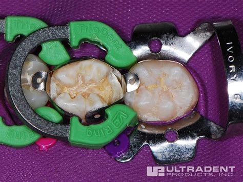 Triodent® V3 Ring Products Category Ultradent Products Inc