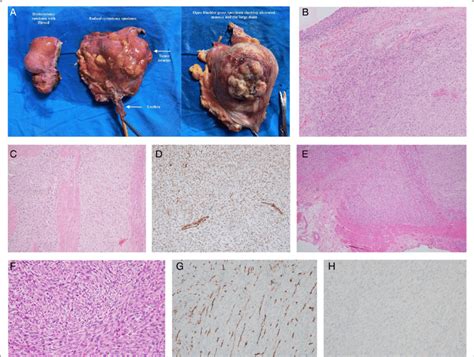 A Radical Cystectomy Specimen Showing Urinary Bladder With A Large