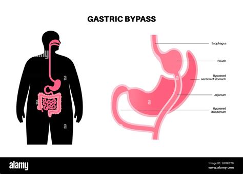 Intervento Di Bypass Gastrico Immagini E Fotografie Stock Ad Alta