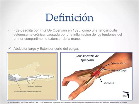 Manejo QuirÚrgico De La Tenosinovitis De Quervainpptx