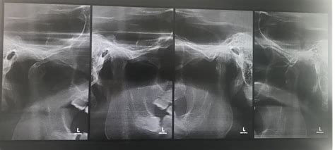 턱관절 엑스레이 마모 상태좀 봐주세요 ㅣ 궁금할 땐 아하