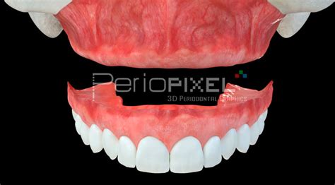 3d Dental Video Zigomatic Implants