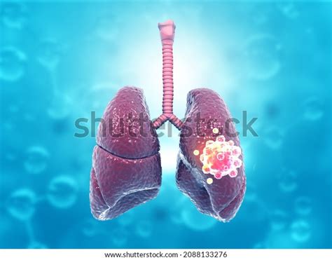 Lung Abscess Microscopy Image Over 16 Royalty Free Licensable Stock Illustrations And Drawings