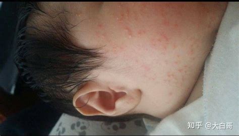 什么是湿疹与疱疹怎么去判断 知乎