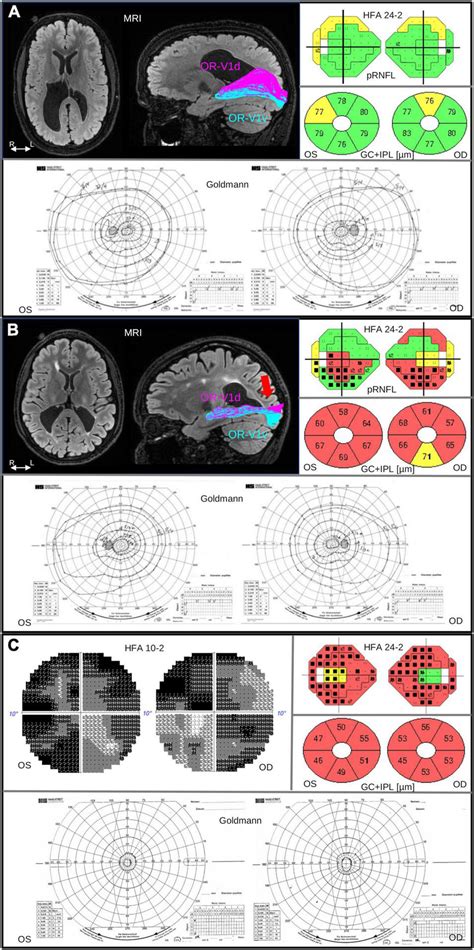 Brain Injuries Were Examined With Mri With Salient Findings