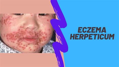 Eczema Herpeticum Causes Diagnosis And Treatment Health Beauty Idea
