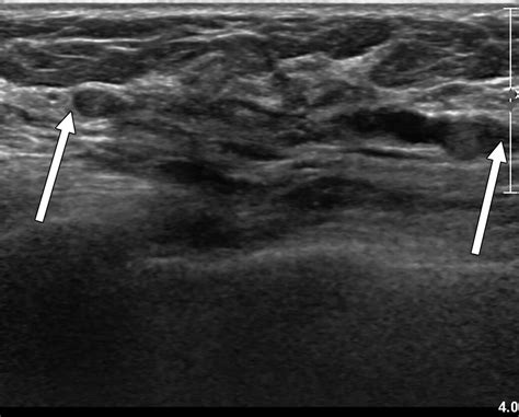 Screening In Patients With Dense Breasts Comparison Of Mammography