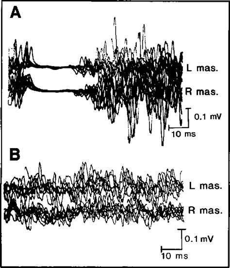 Figure 1 From Trigeminal Sensory Neuropathy Associated With Decreased Oral Sensation And