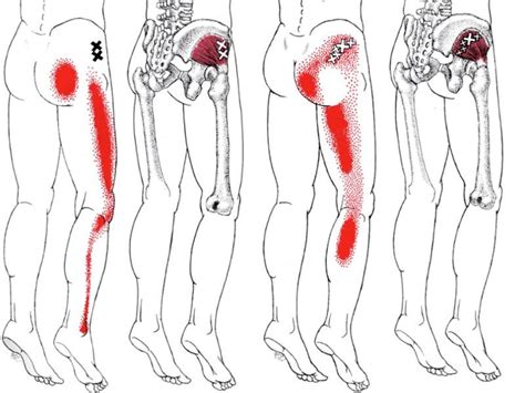 Hamstring Tendinopathy How To Identify And Manage Hamstring Tendinopathy How To Identify And Manage