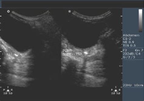 Figure 1 From Ultrasound Of The Pediatric Female Pelvis Semantic Scholar