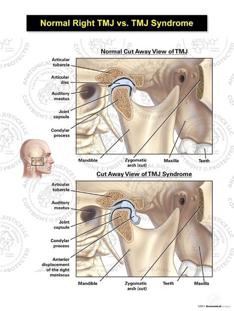 Normal Right Tmj Vs Tmj Syndrome