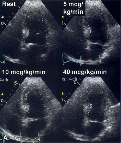 Measurement Of Strain And Strain Rate By Echocardiography Ready For