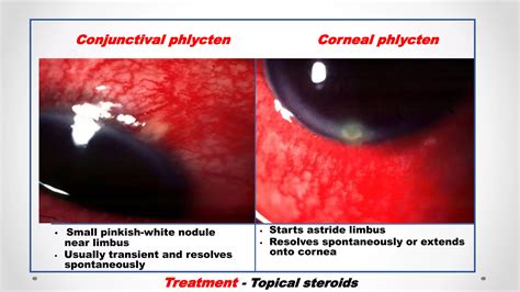 Non Infectious Corneal Ulcers Pptx