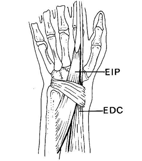 Anomalous Eip With The Muscle Belly Extending Into The Dorsum Of The