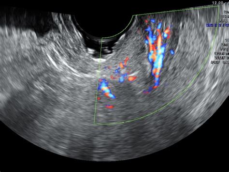 Endometrial Polyp With A Stalk Presenting In The Cervix Looking Through A Transducer
