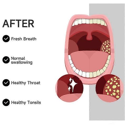 Tonsil Stone Vacuum Remover Tonsil Stone Removal Kit Water Flossers