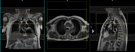 Thymus Mri Thymic Cyst Mri Protocol And Planning Thymoma Mri