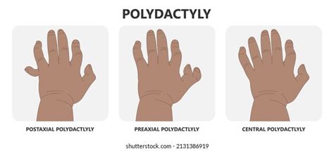 Polidactilia Polydactyly Extra Fingers Or Toes And Corrective