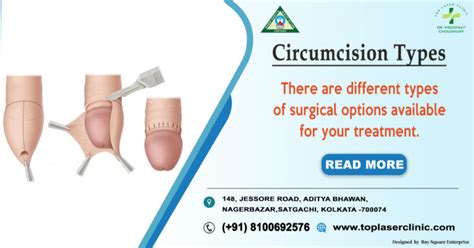 Circumcision Techniques: A Comprehensive Guide to Different Types