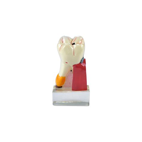 Anatomy Dental Caries Tooth Model