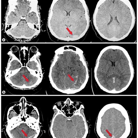 A Initial Plain Ct Of The Brain Showing The Hyperdensity Within The Download Scientific Diagram