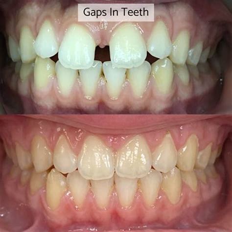 Braces In Fulham Invisalign Ceramic And Metal Braces Sw6 Whites Dental