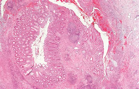 Non Neoplastic And Neoplastic Disorders Of The Appendix Clinical Tree