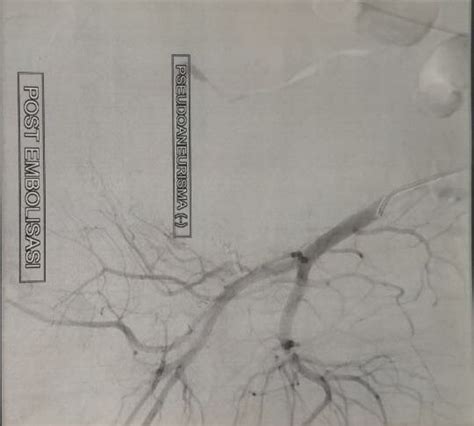 A Pre Embolization B Post Embolization Download Scientific Diagram