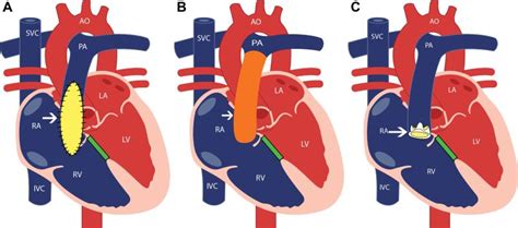 Radiological Society Of North America Rsna On Linkedin Tpvr Is One