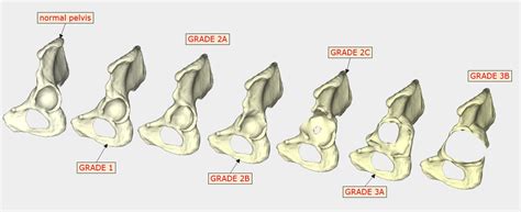 Archivo Stl Clasificación De Paprosky De La Pérdida ósea Acetabular 🩻 ・modelo Para Descargar Y