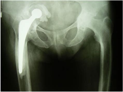 Revision Hip Arthroplasty In Patient With Acetabulum Migration Into
