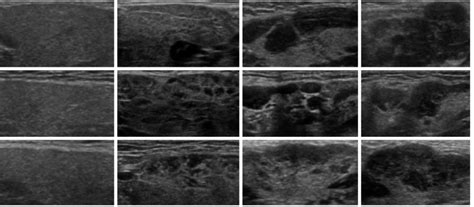 Ultrasonographic Classification Of Echogenicity In Submandibular Download Scientific Diagram